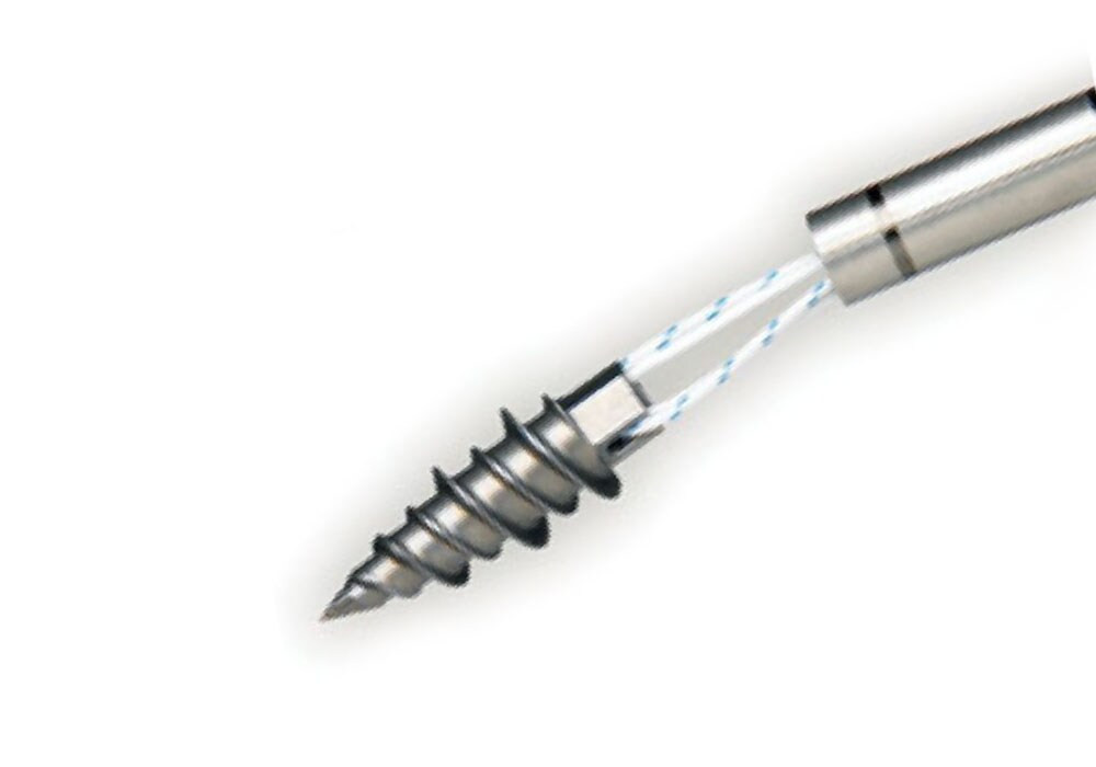 [In Date] Smith & Nephew 5.0 mm TWINFIX Ti Suture Anchor w/ Two #2 ...